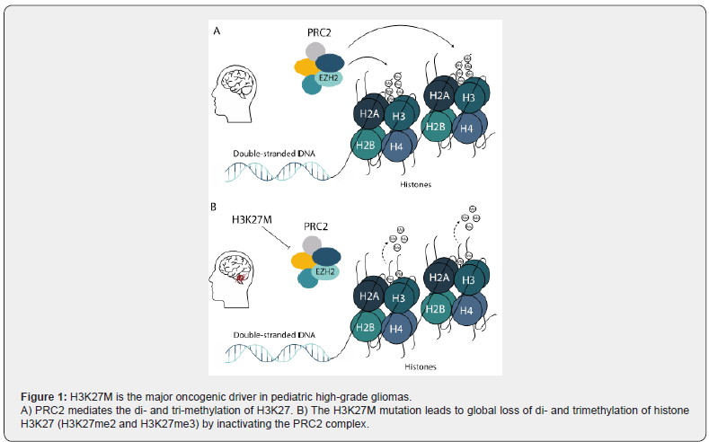 Radio-Resistance and H3K27M Mutation in Pediatric High-Grade Gliomas