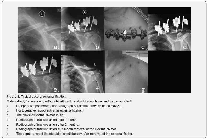External Fixation in the Treatment of Displaced Midshaft Clavicle ...